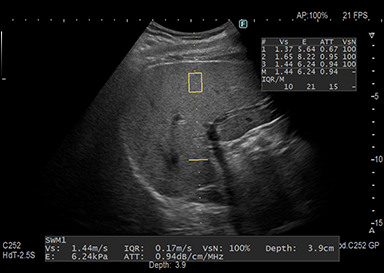ARIETTA 650 DeepInsight：Image Gallery | 富士フイルム [日本]