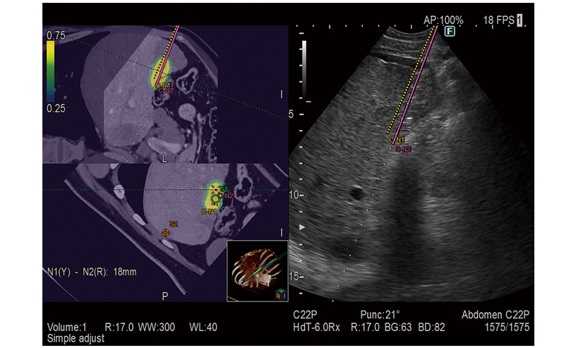 ARIETTA 850 DeepInsight: Uw toepassing | Fujifilm [Nederland]