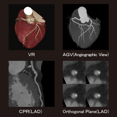 Coronary Analysis | Fujifilm [Singapore]