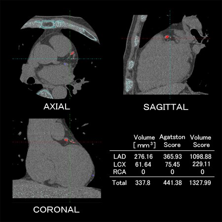 Calcium Scoring | Fujifilm [Singapore]