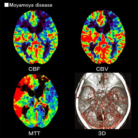 Perfusion Analysis | Fujifilm [Singapore]